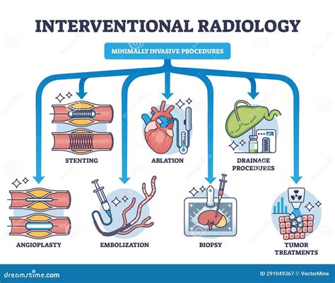 Interventional Radiology As Minimally Invasive Procedures Outline Diagram Stock Vector