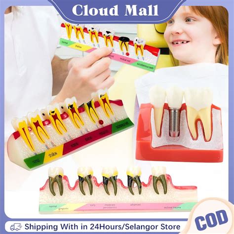 Dental Caries Model Caries Classify Pathological Model Dental Teaching