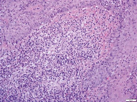 Plect Or Pplect Granulomatous Pyoderma Gangrenosum In The Differential Diagnosis Of The