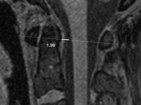 Transverse Ligament C Spine