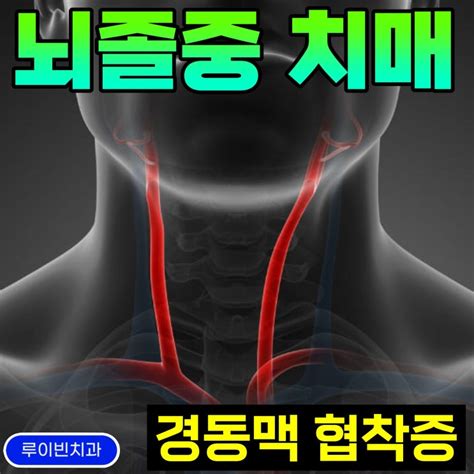 경동맥 협착증 두께 위치 통증 증상 원인치료 병원 뇌졸중치료 네이버 블로그
