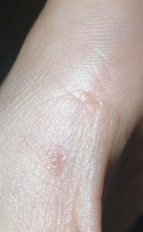 Reinfection Or Post Scabies Rscabies