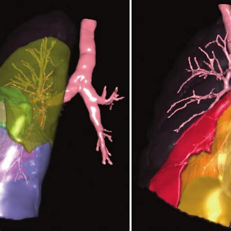 2 Left Lung Segmental Anatomy Created By Software From A Ct Scan A