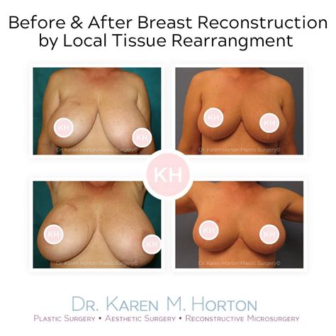 Before And After Breast Reconstruction By Breast Reduction And Lift In