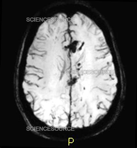Photograph Severe Traumatic Brain Injury Mri Science Source Images