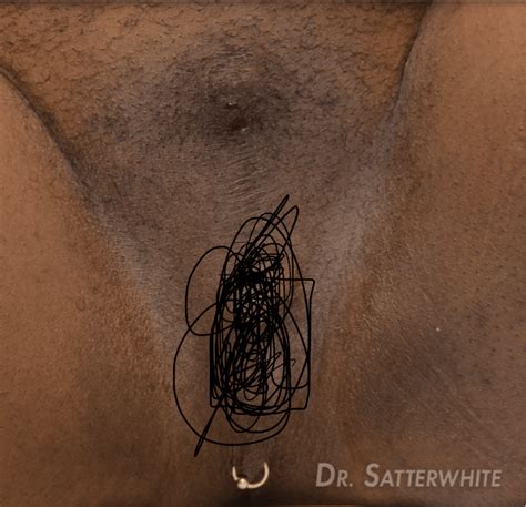 Nullification Chirurgia Per Annullare Il Sesso Feministpost