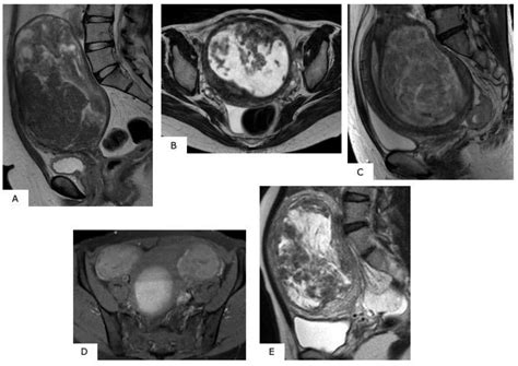 Healthcare Free Full Text Differential Diagnosis Of Uterine Leiomyoma And Uterine Sarcoma