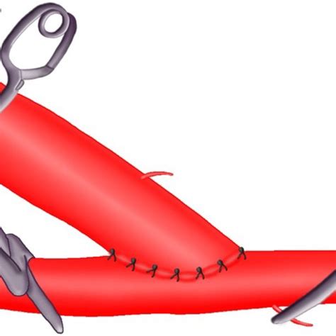 Sequence Of Removing Temporal Occlusion Clips 1 The Distal Recipient