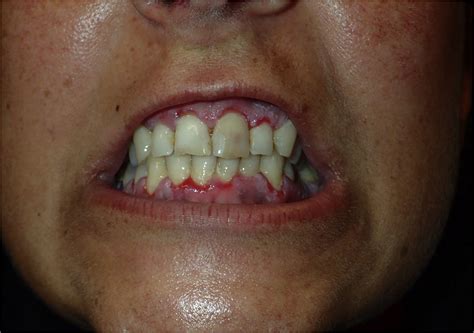 Painful Ulceration Of The Vulva American Journal Of Obstetrics