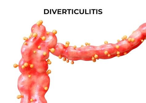 La Diverticulitis Es Una Enfermedad Que Se Produce Cuando Los Divertículos Del Intestino Grueso