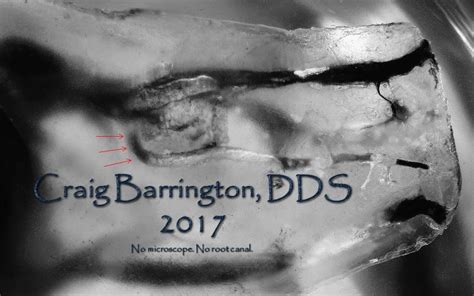 Craig Barrington Dds This Mb2 In This Upper Second Molar Represents That Average Path The