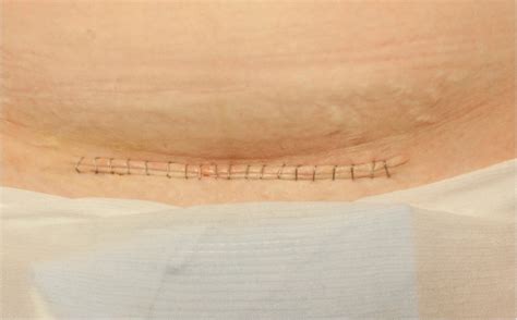 Types Of Lower Segment Cesarean Section Medisuggest