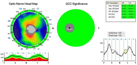 Gcc Gcl Thickness Parameters Could Be Reliable Predictors Eb