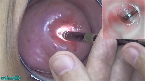 Watch Inside The Uterus Of Asian Woman With Endoscope Camera Into Cervix Xnxx Com