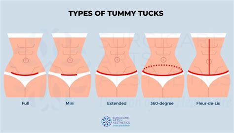 Tummy Tuck Scars Position Healing And Treatment