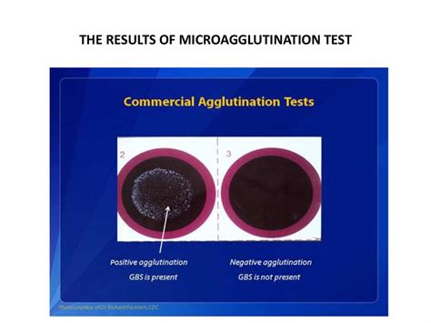 Microagglutination Test Procedure At Nicholas Ratcliffe Blog
