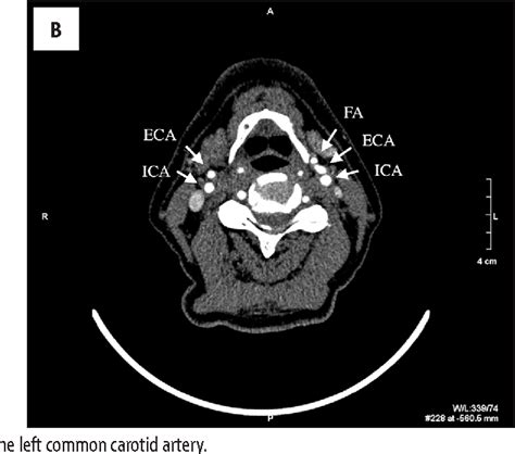 Carotid Artery Anatomy Ct My Xxx Hot Girl