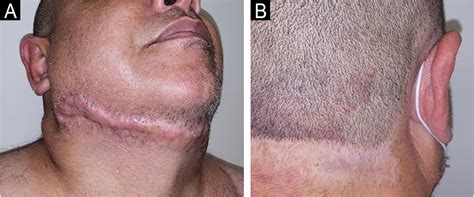 Multifocal Pyoderma Gangrenosum Mimicking Disseminated Cutaneous Leishmaniasis ‒ A Diagnostic