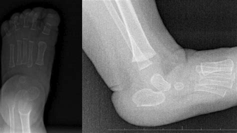 Case 1 Ap And L X Ray Before Surgery After 5 Casts Download Scientific Diagram