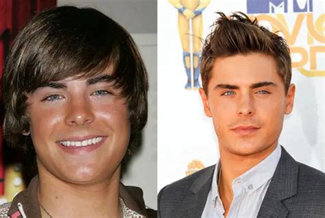 Zac Efron Chin Iimplant And Nose Job Plastic Surgery Before And After