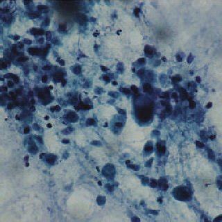 FNAC Of Scalp Swelling Showing A Group Of Highly Pleomorphic Large Download Scientific Diagram