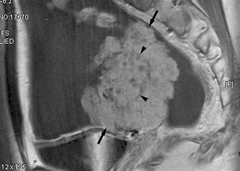 Borderline Serous Surface Papillary Tumor Of The Ovary Mri