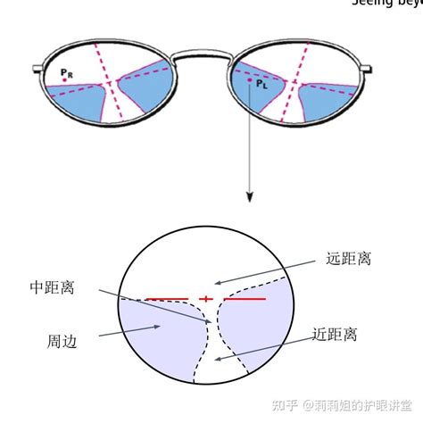 近视眼老花渐进多焦点来解决 知乎