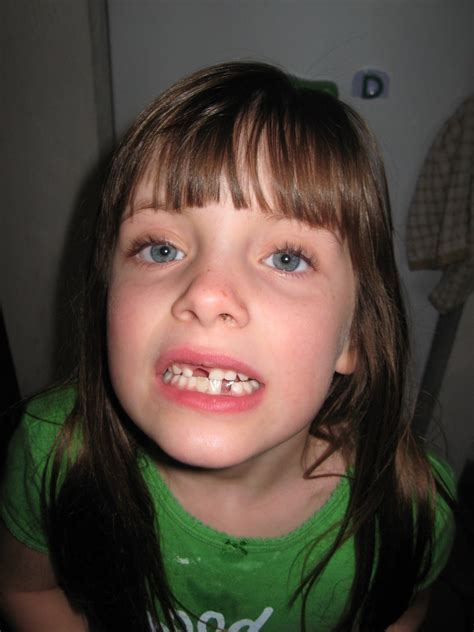 Girl Missing Teeth Smile