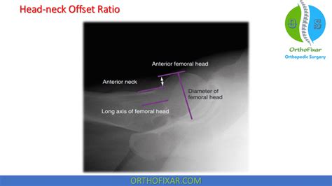 Femoroacetabular Impingement Fai Orthofixar