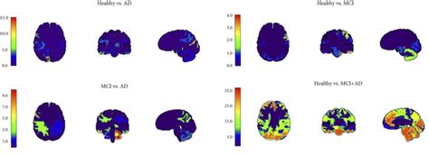 Multivariate Mediation Analysis With Voxel Based Morphometry Revealed The Neurodegeneration