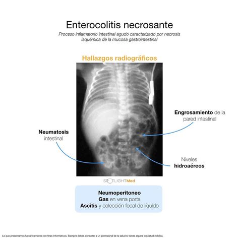 Radiografia De Enterocolite Necrosante Leite Humano Como Fator De