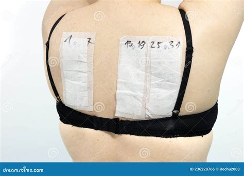 Patch Tests Tests To Detect Skin Allergens Such As Metals Preservatives Fragrances Medicines