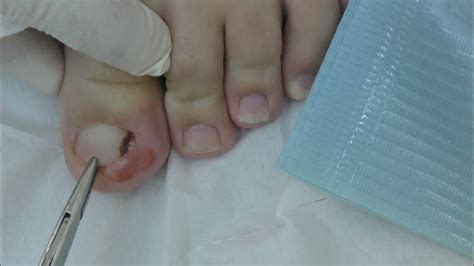 Ring Block Analgesia Of A Left Hallux Big Toe Followed By Exctraction Of The Nail Youtube