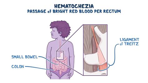 Approach To Hematochezia Pediatrics Clinical Sciences Osmosis