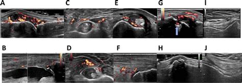 Typical Pathological Findings Of Msus In Inflammatory Arthritis A Download Scientific