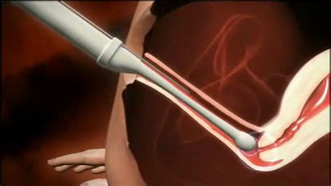Sperm Donation Process Video