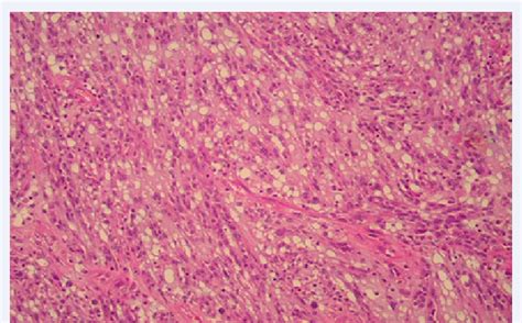 Proliferation Of Tubular And Fusiform Architecture Within A Myxoid Download Scientific Diagram