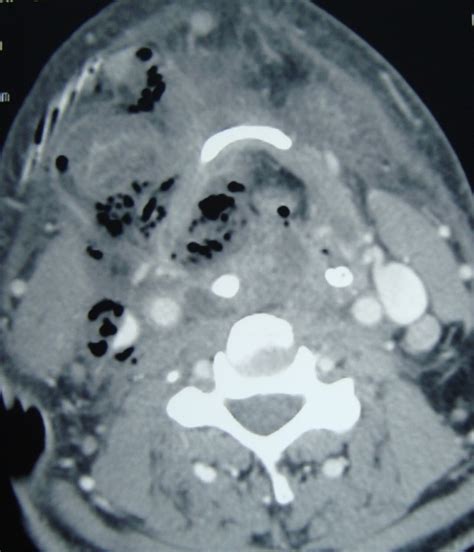 Axial View Of Computed Tomography At The Level Of The Mandibular Border Download Scientific