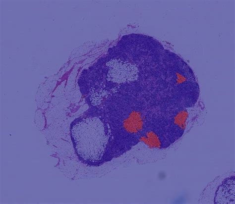 Using Transfer Learning For Breast Cancer Detection By Smarth Gupta