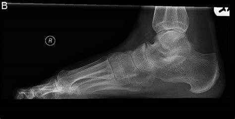 Subtalar Joint The Foot And Ankle Online Journal