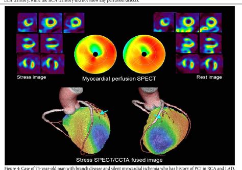 Pdf Cardiac Spectct Imaging Ct Attenuation Correction And Spectct