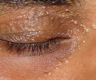 Syringomas Upper Eyelids