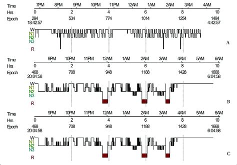 Sleep Histogram A Sleep Histogram In A Patient With Lgi1 Antibody