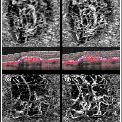 Appearance Of Choroidal Neovascularization Cnv According To