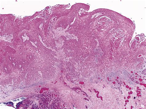 Xeroderma Pigmentosum Ento Key