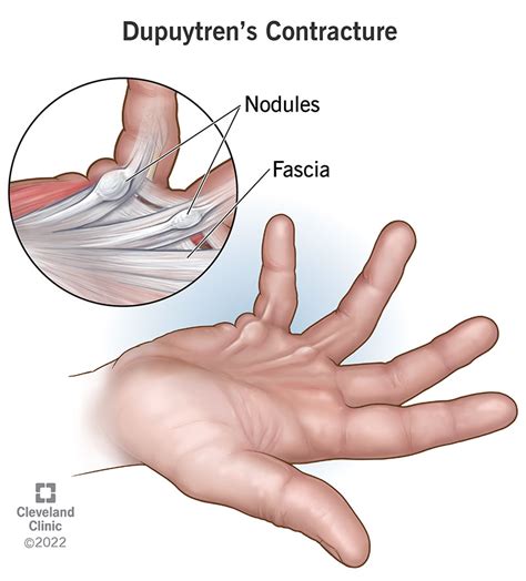 Dupuytrens Contracture