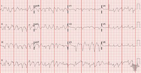 Left Bundle Branch Block ECG Stampede