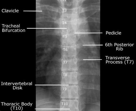 Spine X Ray How To Interpret The Result Healthy Food Near Me