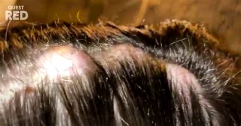 UK S Dr Pimple Popper Bursts Marble Shaped Cysts On Woman S Scalp In Gross New Video The US Sun