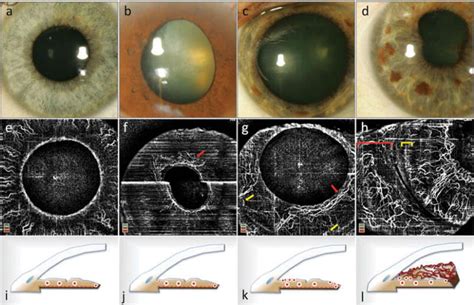 Anterior Segment Optical Coherence Tomography Angiography For Identification Of Iris Vasculature